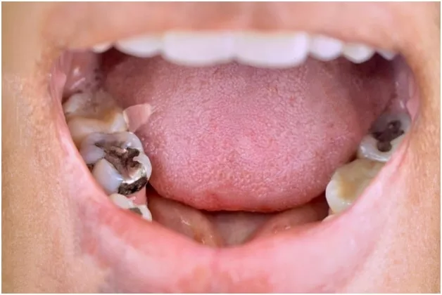 Rotten Tooth Extraction: Signs & Treatment Guide