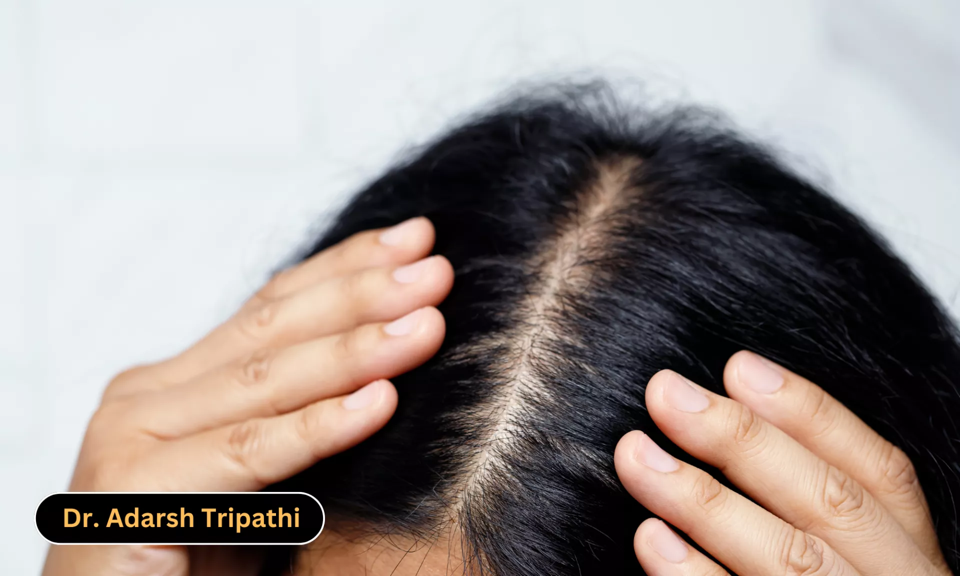 Scalp Threads Treatment in Delhi | Dr. Adarsh Tripathi Clinic