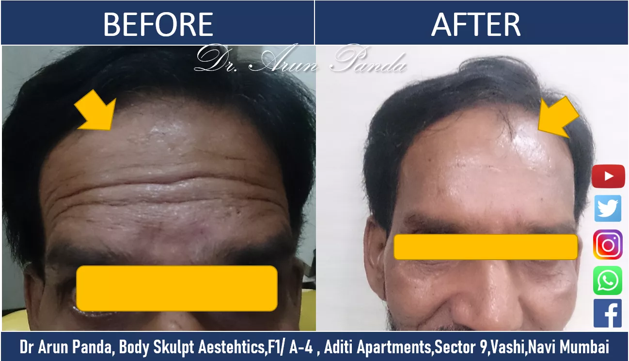 Botulinum toxin (Botox) for forehead wrinkles removal in Navi Mumbai