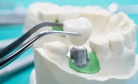 What to Do If Your Crown Falls Out and Doesn't Hurt