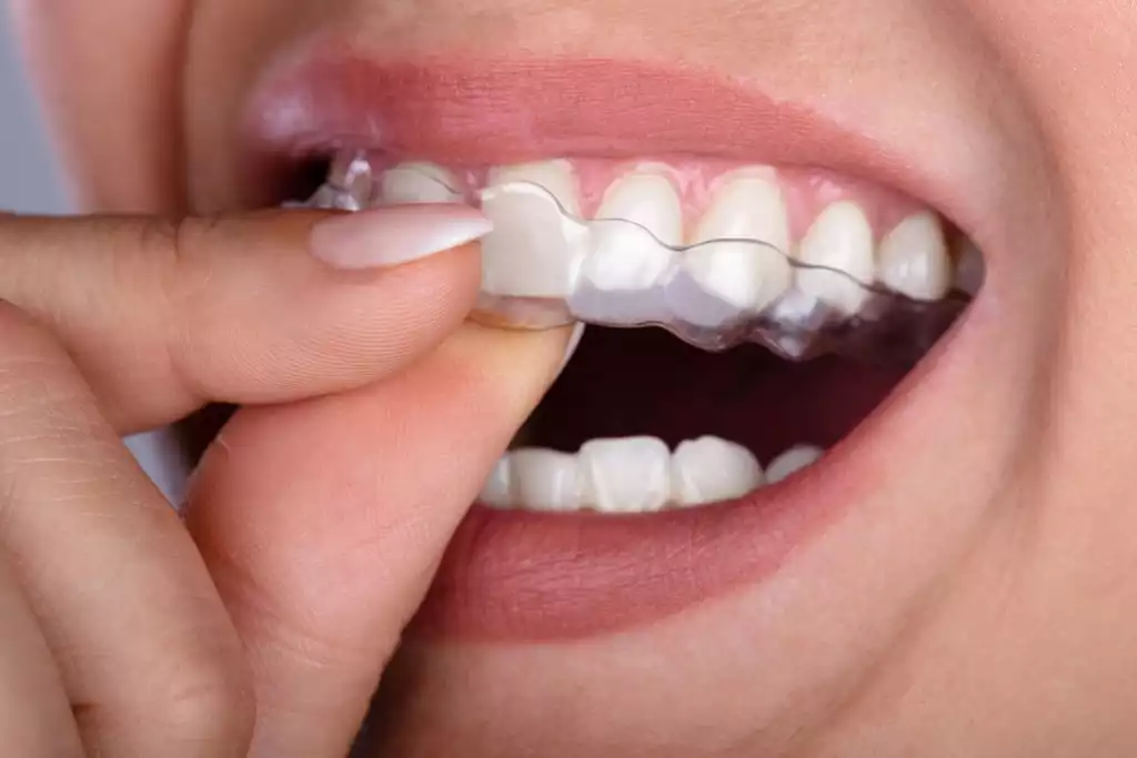 Invisalign Without Attachments: Minimal Visibility, Maximum Comfort ...