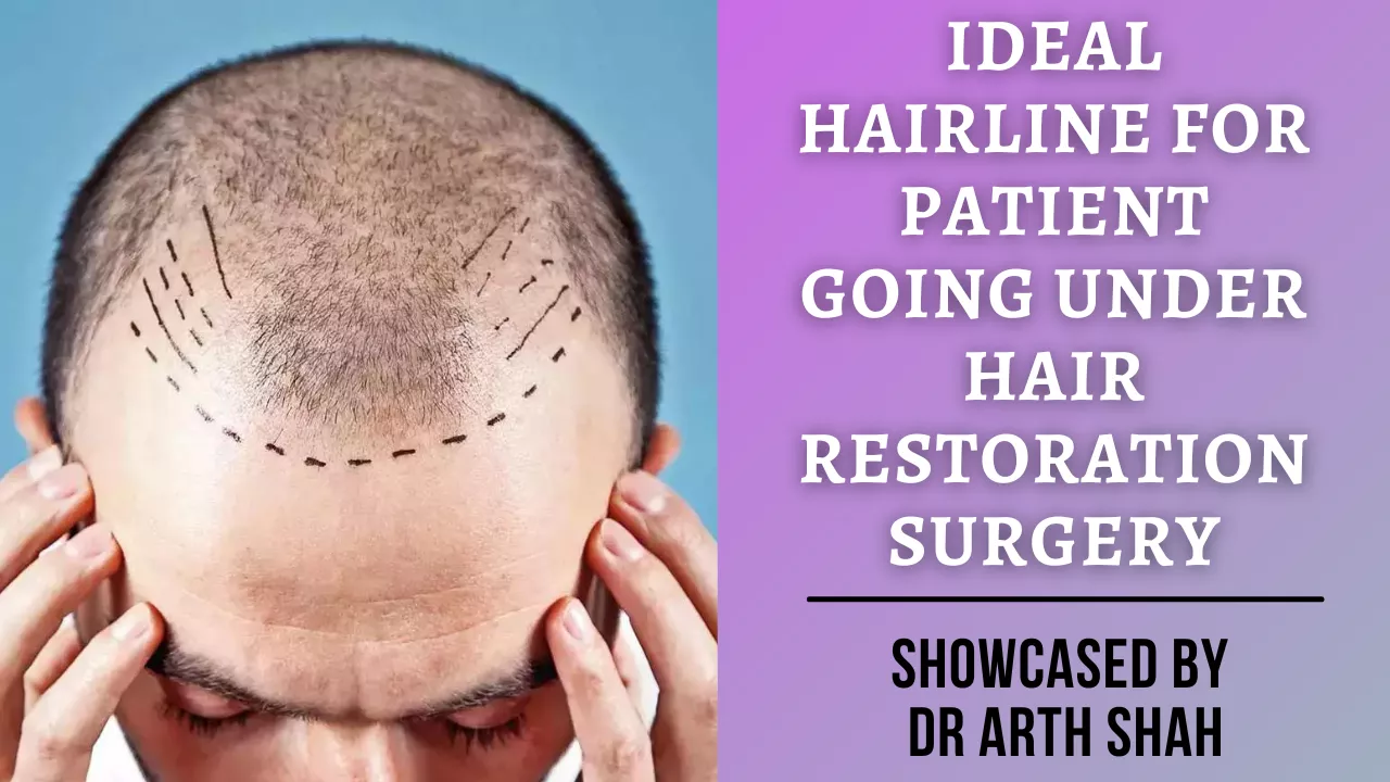 Ideal hairline for patient going under hair restoration surgery in ...