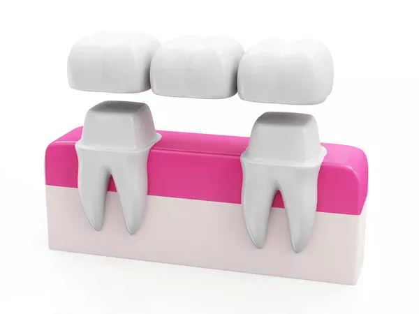 Discover the Key Signs You Need Dental Bridges in Mahopac NY for ...