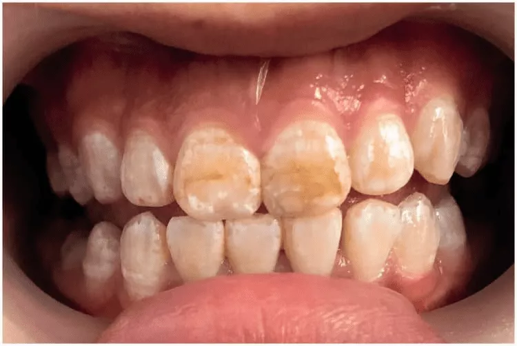Yellow Spots on Teeth: Causes and Fixes