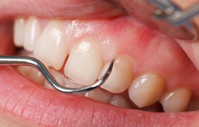 How Long Does It Take for Tartar to Form on Teeth?