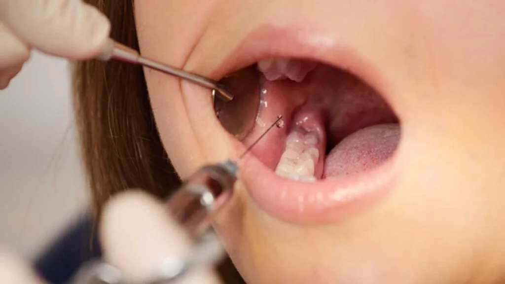 How Bad Is Wisdom Teeth Removal Without Anesthesia?
