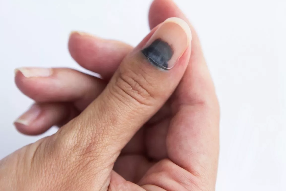 Ongle noir : symptômes, causes et traitement - Manucure Beauté
