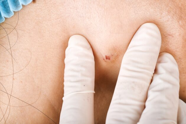 Microkyste : causes et solutions pour s’en débarrasser