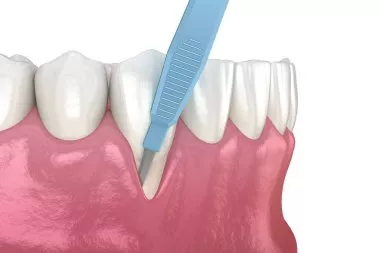 Scaling and Root Planing Treatment: Deep Cleaning for Healthier Gums