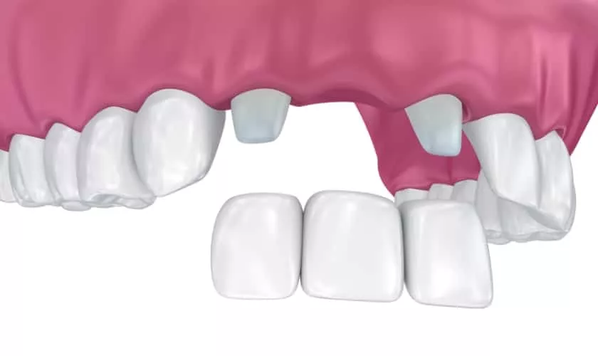 What is the Most Common Cause of Fixed Dental Bridge Failure?